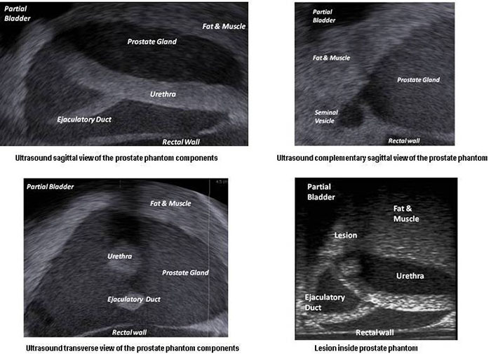 Brachytherapy Prostate Ultrasound Phantom With Catheter