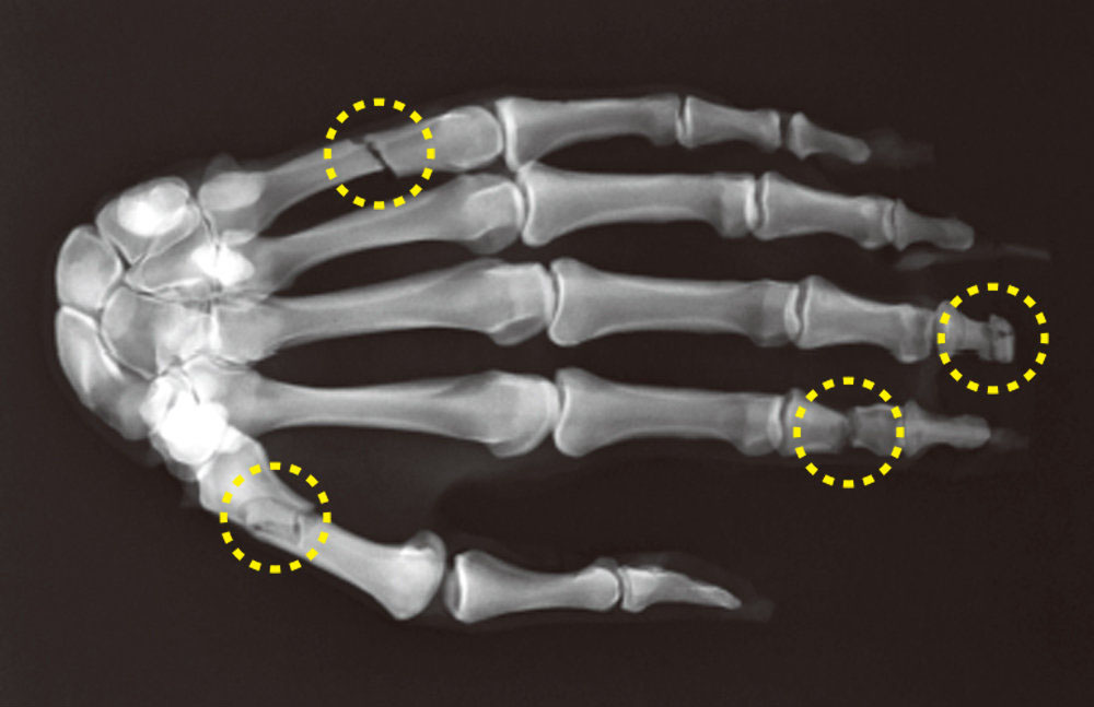 Xray Phantom Lower Arm Transparent